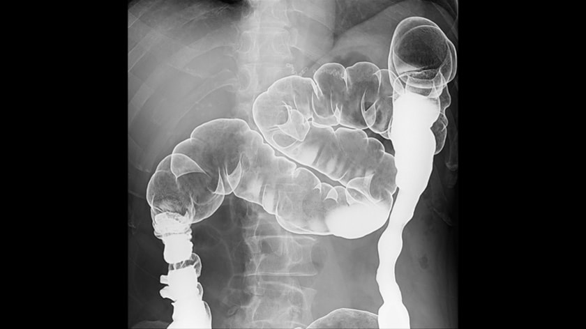 Patient-side R/F System - FLUOROspeed X1 edition | Shimadzu Medical ...