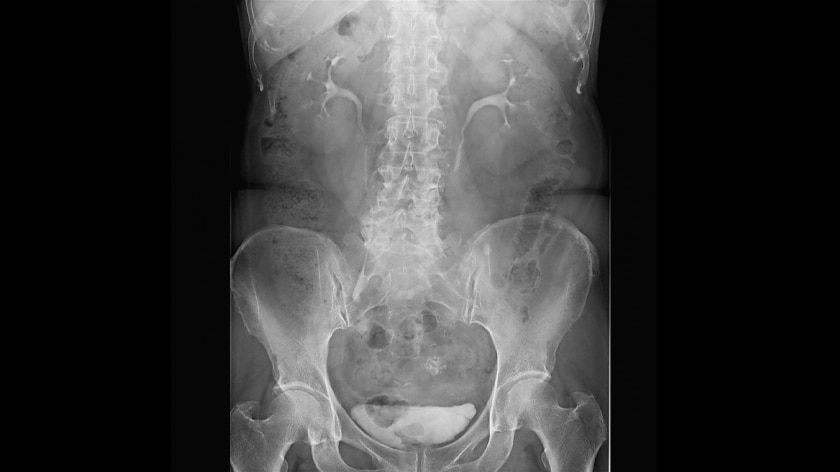 Patient-side R/F System - FLUOROspeed X1 edition | Shimadzu Medical ...