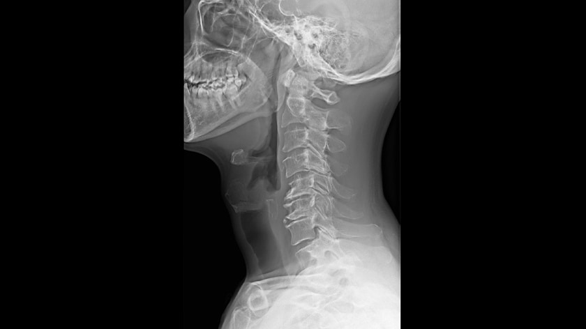 Patient-side R/F System - FLUOROspeed X1 edition | Shimadzu Medical ...